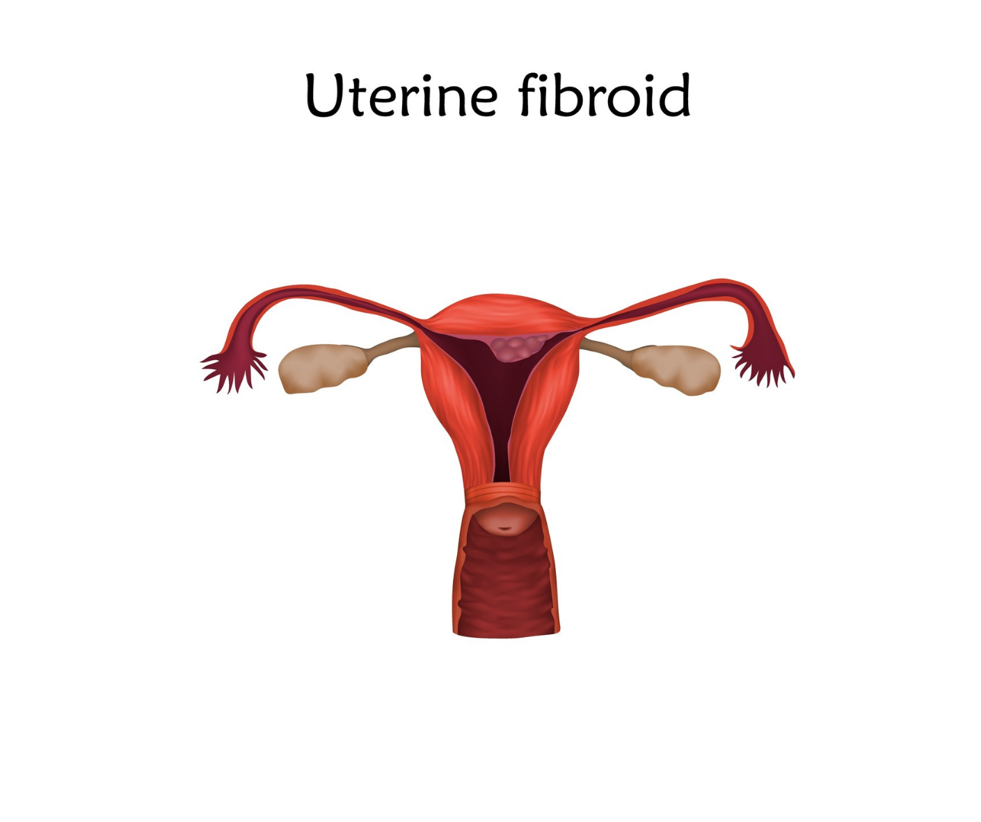 Myómy – postrach žien po štyridsiatke.